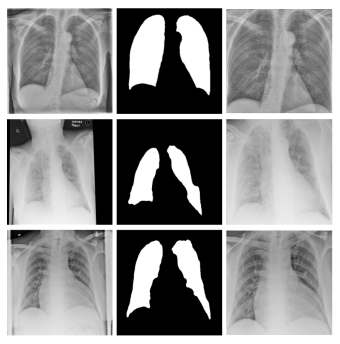 Optimising Chest X-Rays for Image Analysis by Identifying and Removing ...